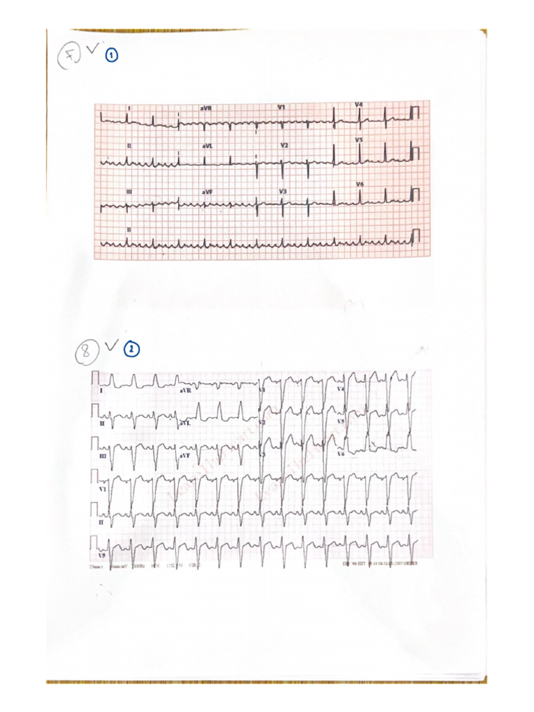 Contoh EKG | PDF
