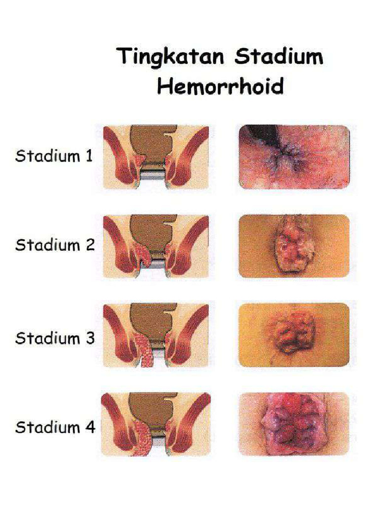 Tingkatan-Stadium-Hemoroid | PDF