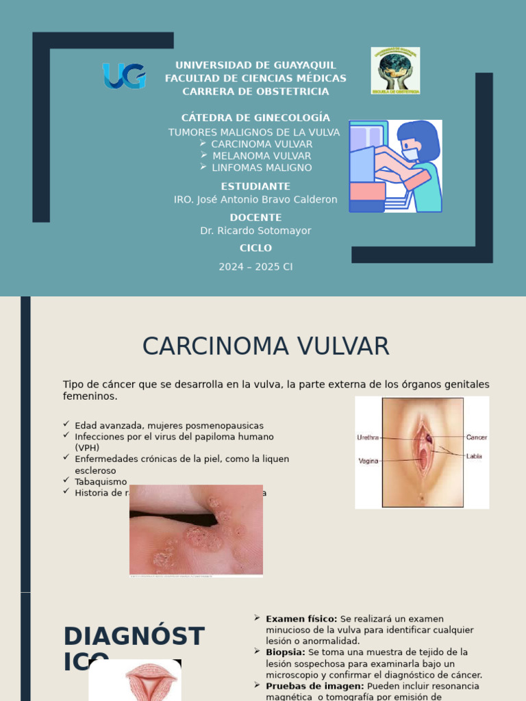Carcinoma Vulvar Melanoma Linfoma | PDF | Cáncer | Metástasis