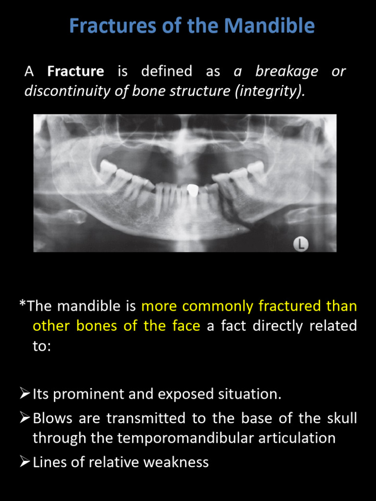 Lec.2,3 - Fracture Mandible | PDF | Bone | Clinical Medicine