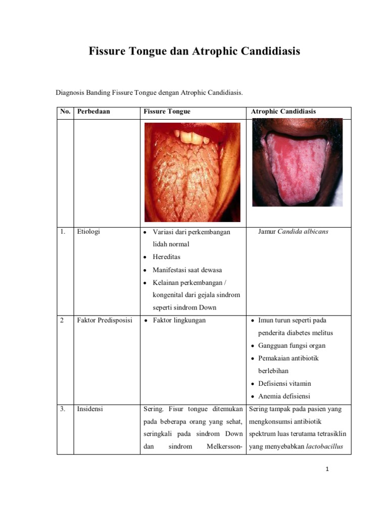 (PAPER) Fissure Tounge Dan Atrophic Candidiasis | PDF