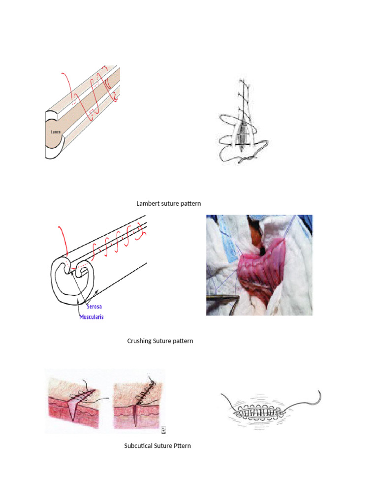 Suture Pattern Shahrer | PDF