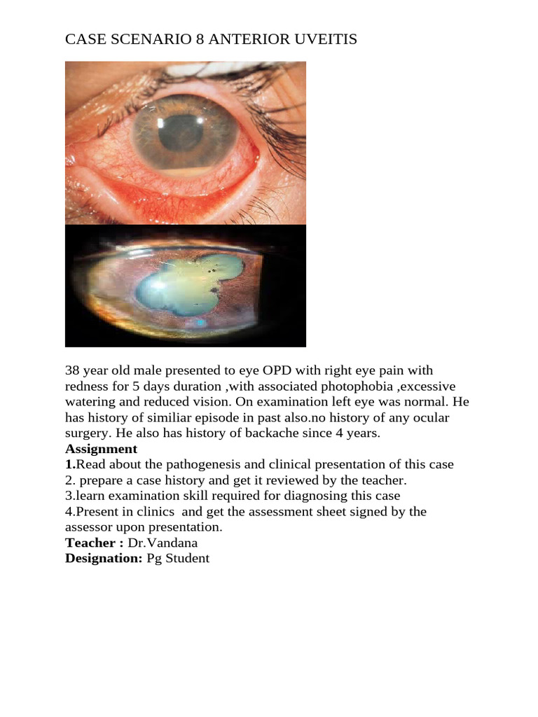 Anterior Uveitis Case Study | PDF