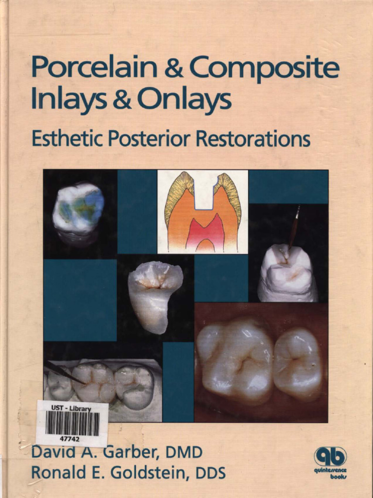 Porcelain and Composite Inlays and Onlays, Esthetic Posterior Restorations | PDF