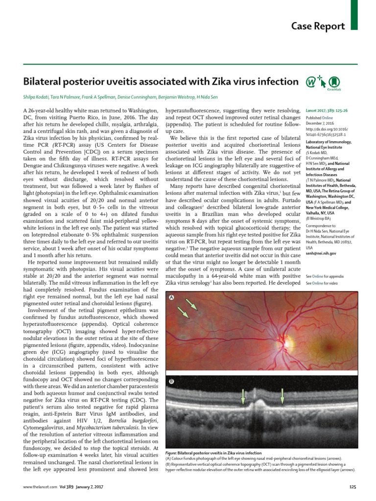 Bilateral Posterior Uveitis Associated With Zika V | PDF | Zika Fever ...