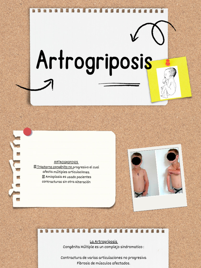 Artrogriposis | PDF | Enfermedades y trastornos | Medicina CLINICA