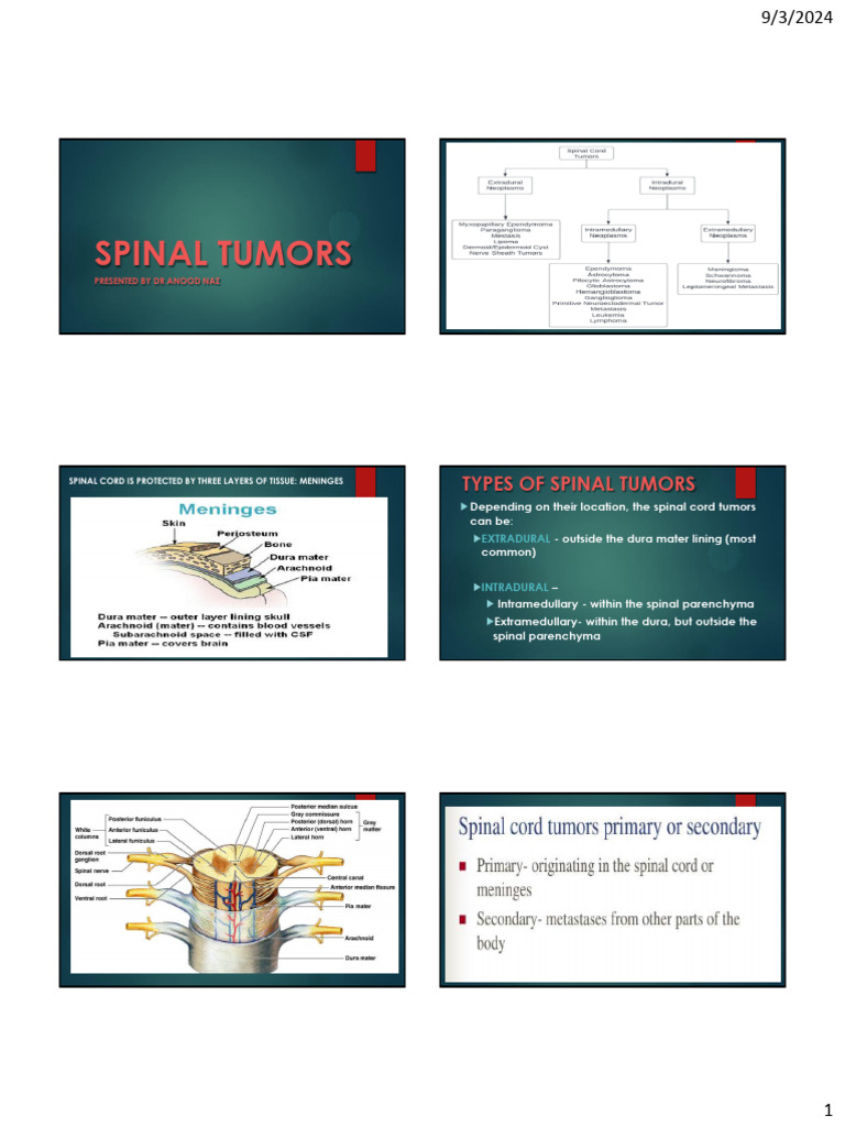 Spinal Tumors: Types and Symptoms | PDF