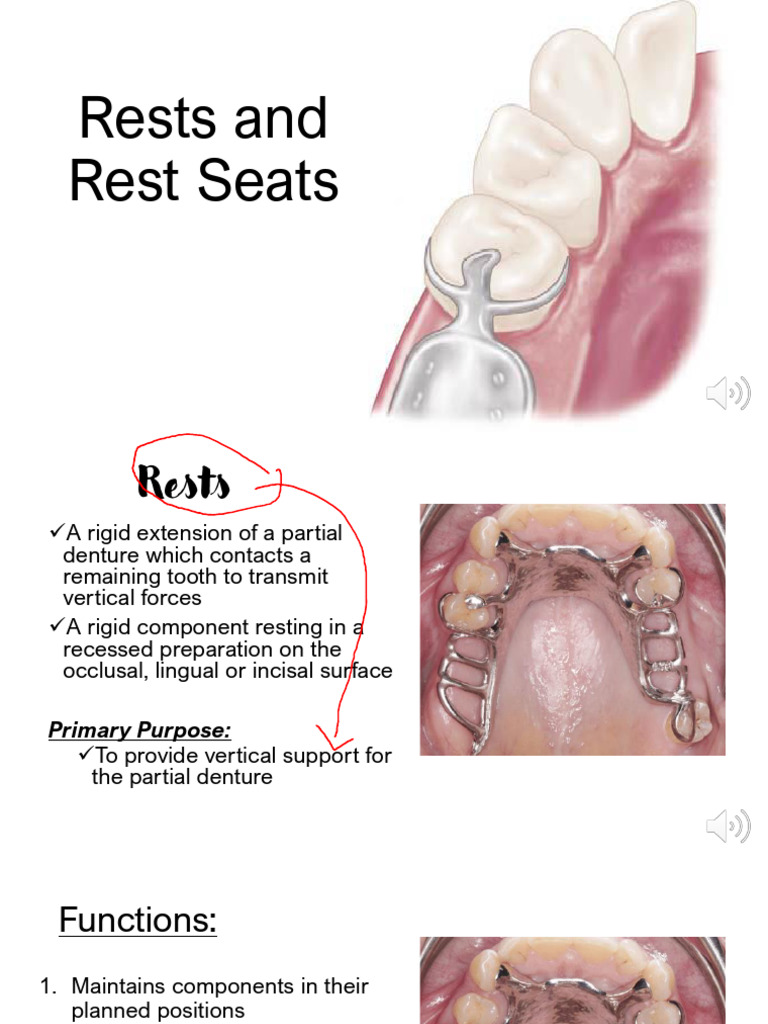 Partial Denture Rest Design Guide | PDF | Dentistry Branches