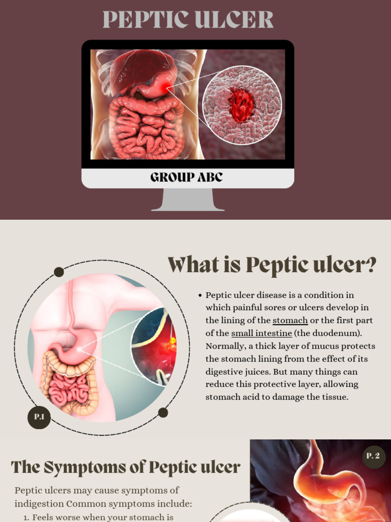 PEPTIC ULCER CLASS REPORT | PDF | Indigestion | Medical Specialties