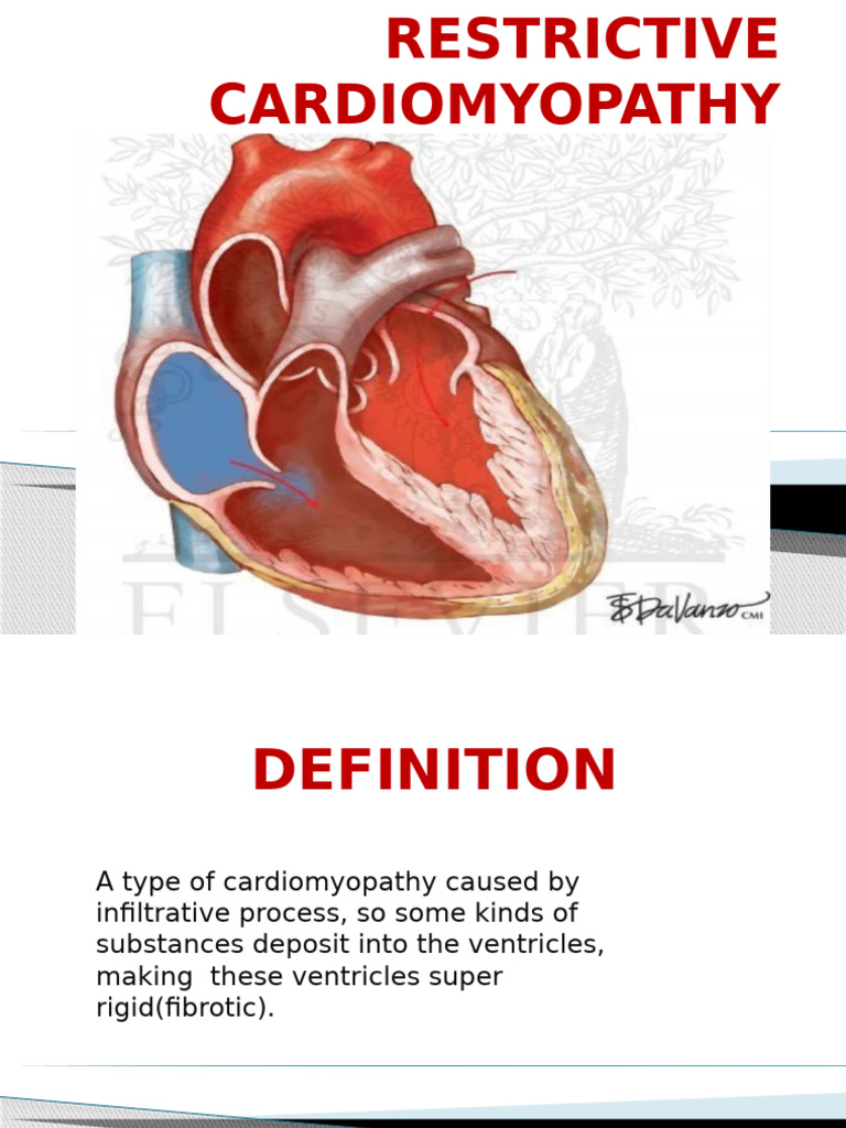 Restrictive Cardiomyopathy | PDF