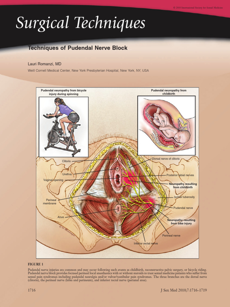 Techniques Of Pudendal Nerve Block Pdf Pelvis Nervous System
