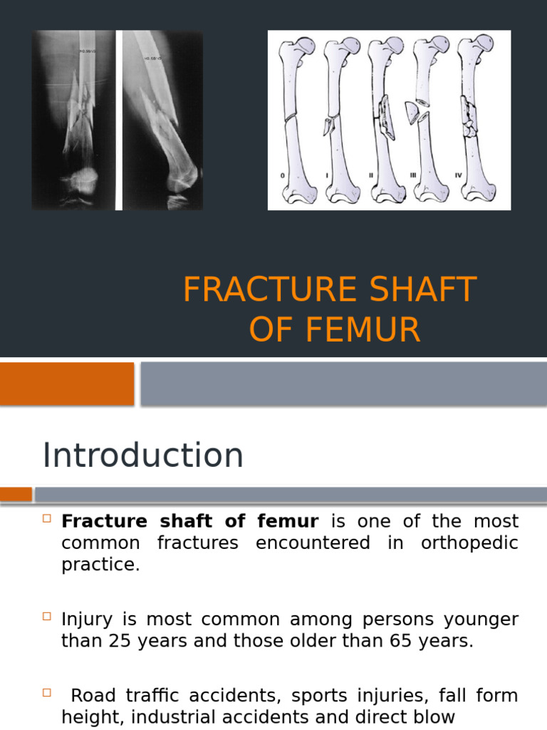 Femur Shaft Fracture: Causes & Treatment | PDF | Orthopedic Surgery | Hip