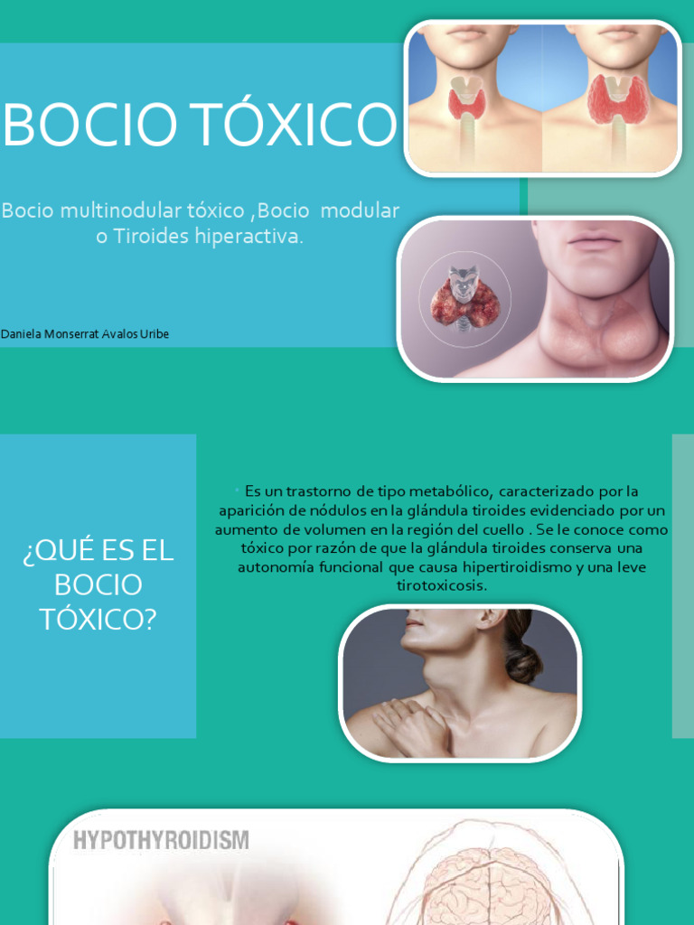 Bocio Tóxico - Daniela Ávalos | PDF | Hipertiroidismo | Tiroides