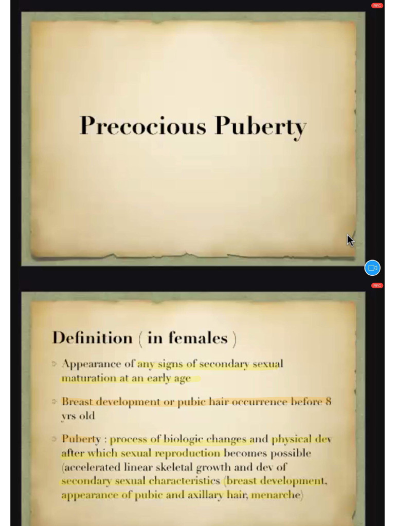 10 Precocious Puberty | PDF