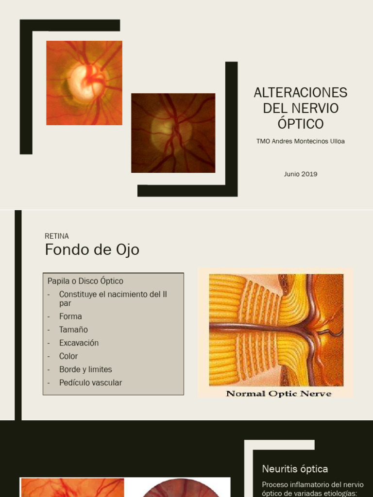 Clase 3 Alteraciones Del Nervio Ã Ptico | PDF | Percepción visual | Nervio