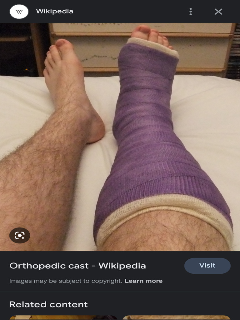 Casted Leg - Google Search | PDF