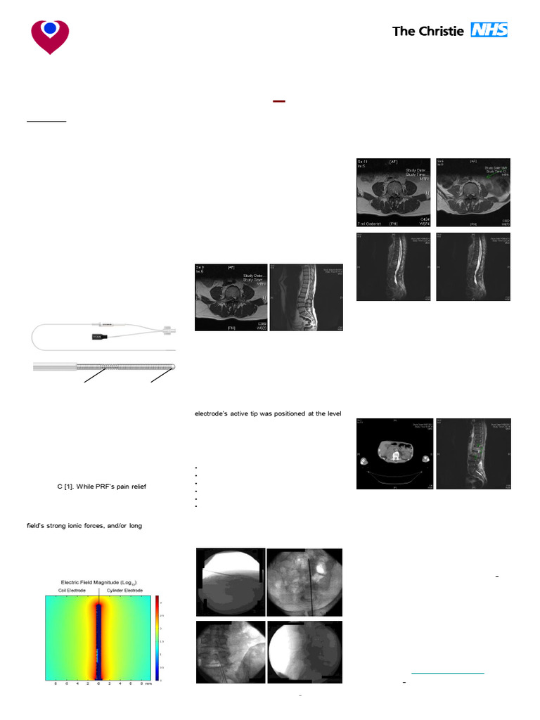 Epidural Pulsed RF for Lumbar Pain Relief | PDF | Pain | Pain Management