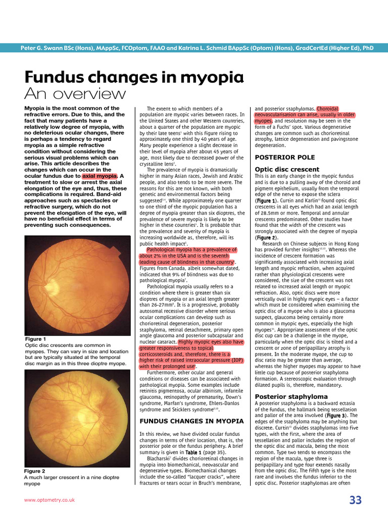 Fundus Changes in Myopia | PDF | Myopia | Glaucoma