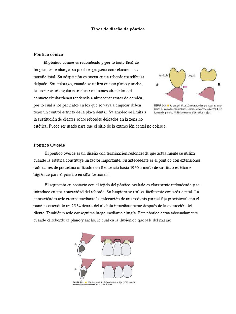 Tipos de Pónticos en Prótesis Fija | PDF