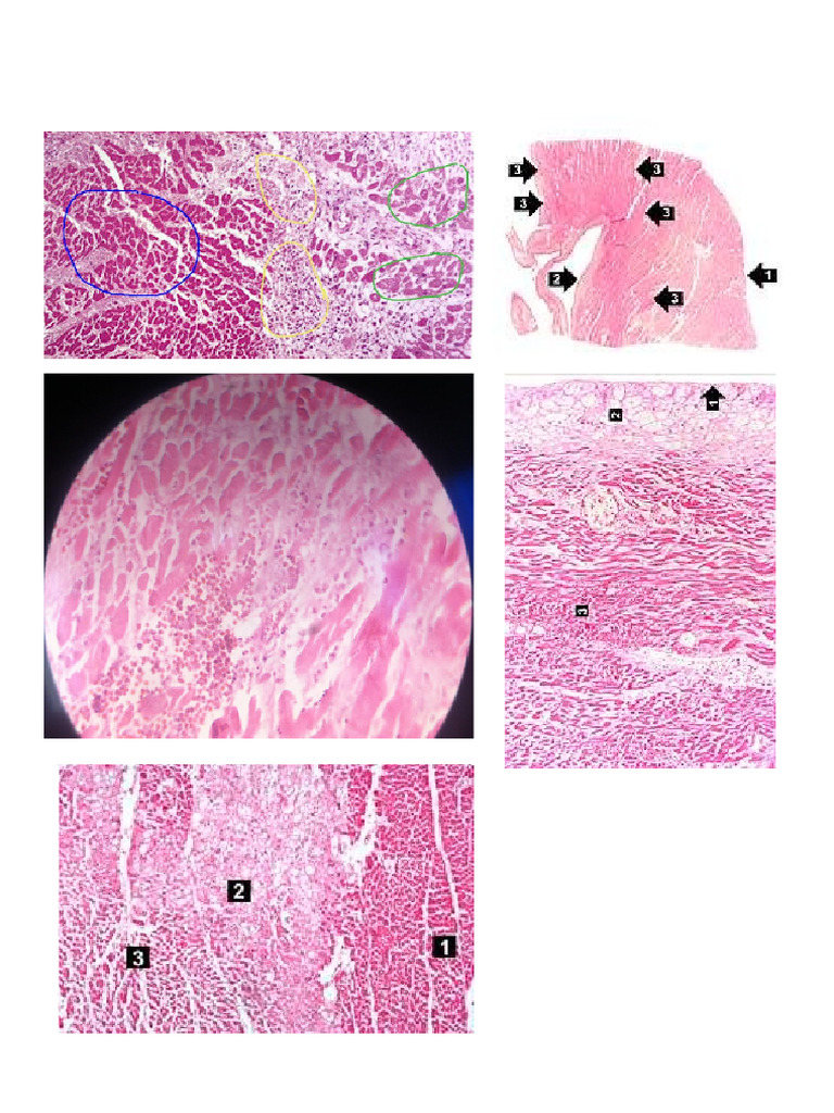 Histología del Infarto Miocardio | PDF | Inflamación | Medicina CLINICA