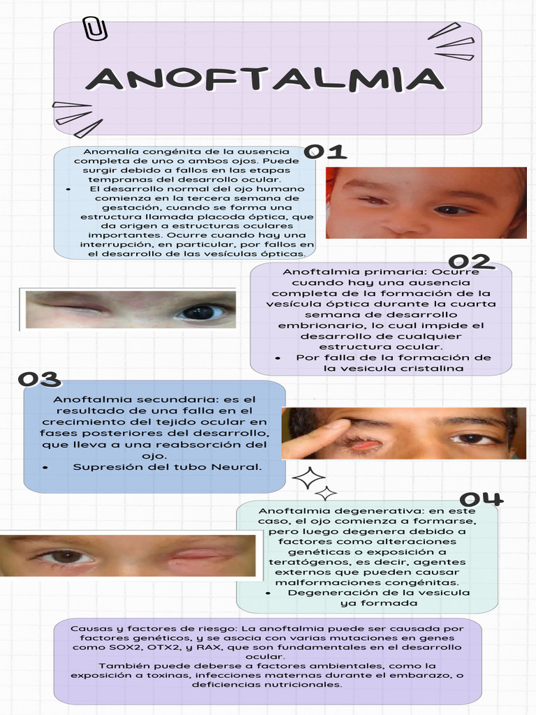 Anoftalmia | PDF | Medicina | Medicina CLINICA