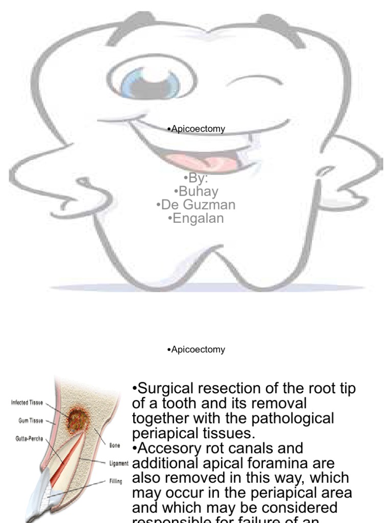 Apicoectomy | PDF