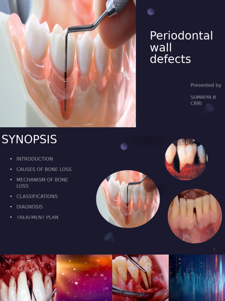 Periodontal Wall Defects | PDF | Periodontology | Bone