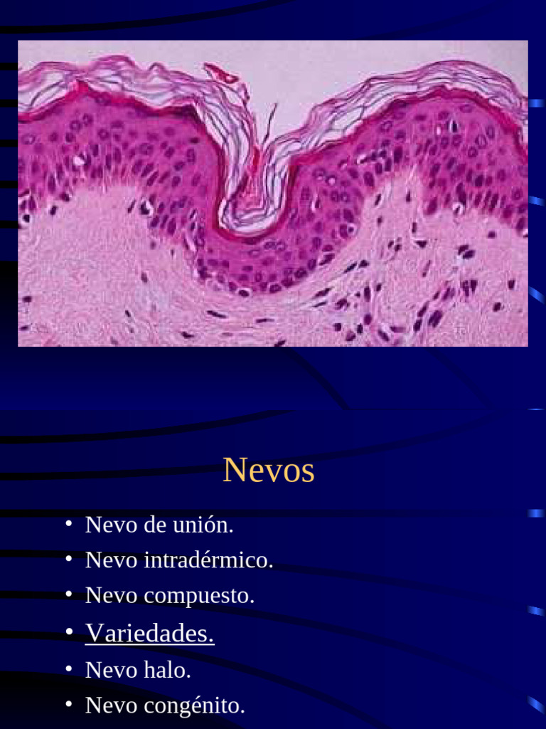 Tumores Melanicos 2024 | PDF | Melanoma | Metástasis