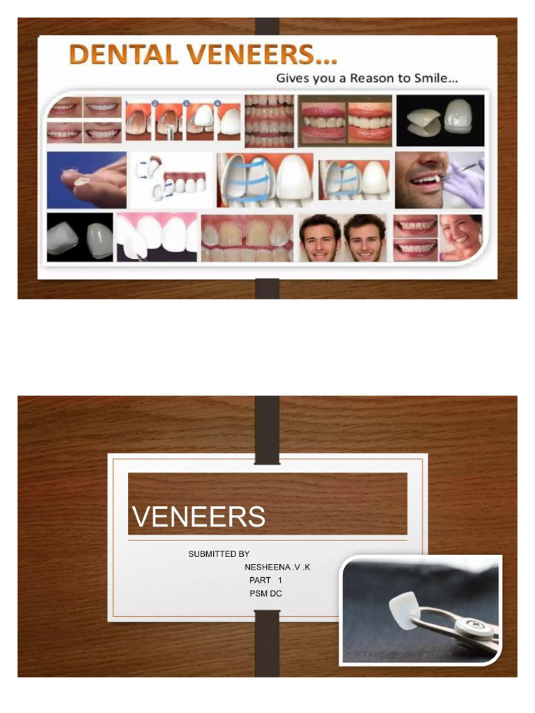 veneers | PDF