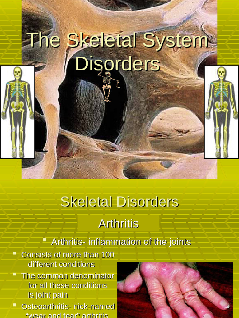 Grade 8 9 Advanced Science Skeletal System Disorders | PDF | Arthritis ...