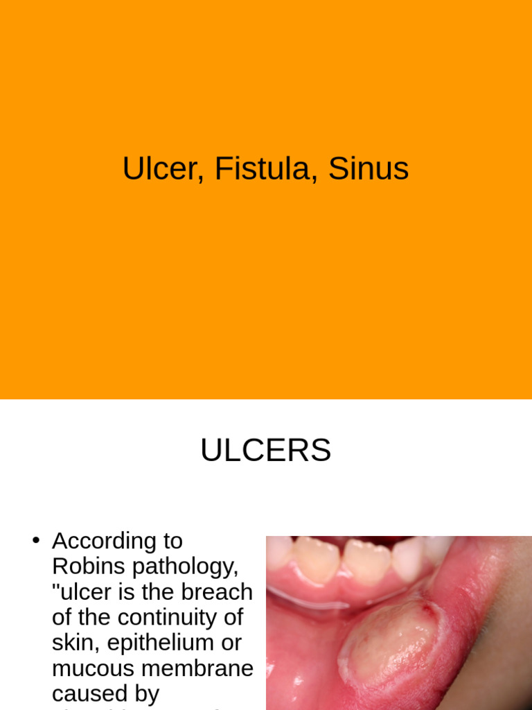 Ulcers | PDF