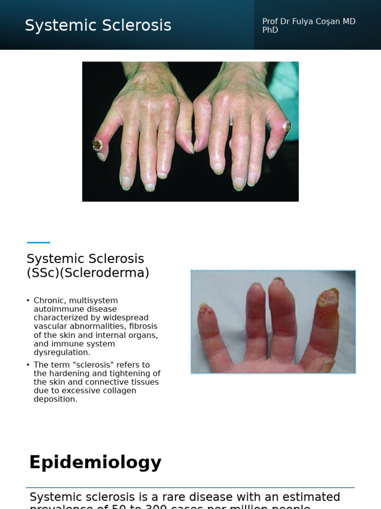 Systemic Sclerosis Overview 2025 | PDF | Causes Of Death | Human ...