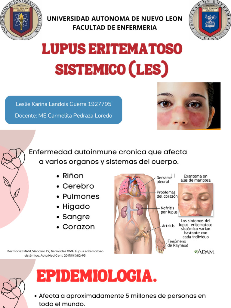 LUPUS | PDF | Medicina CLINICA | Especialidades Medicas
