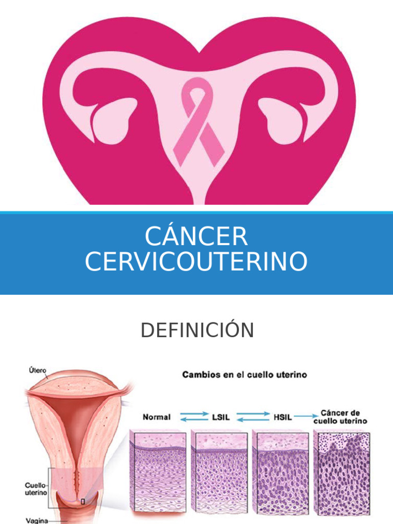 Cáncer CervicoUterino | PDF | Cáncer de cuello uterino | Cáncer