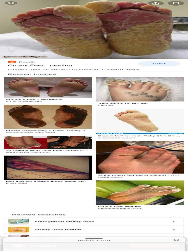 Crusty Toes - Google Search 3 | PDF | Young Adult