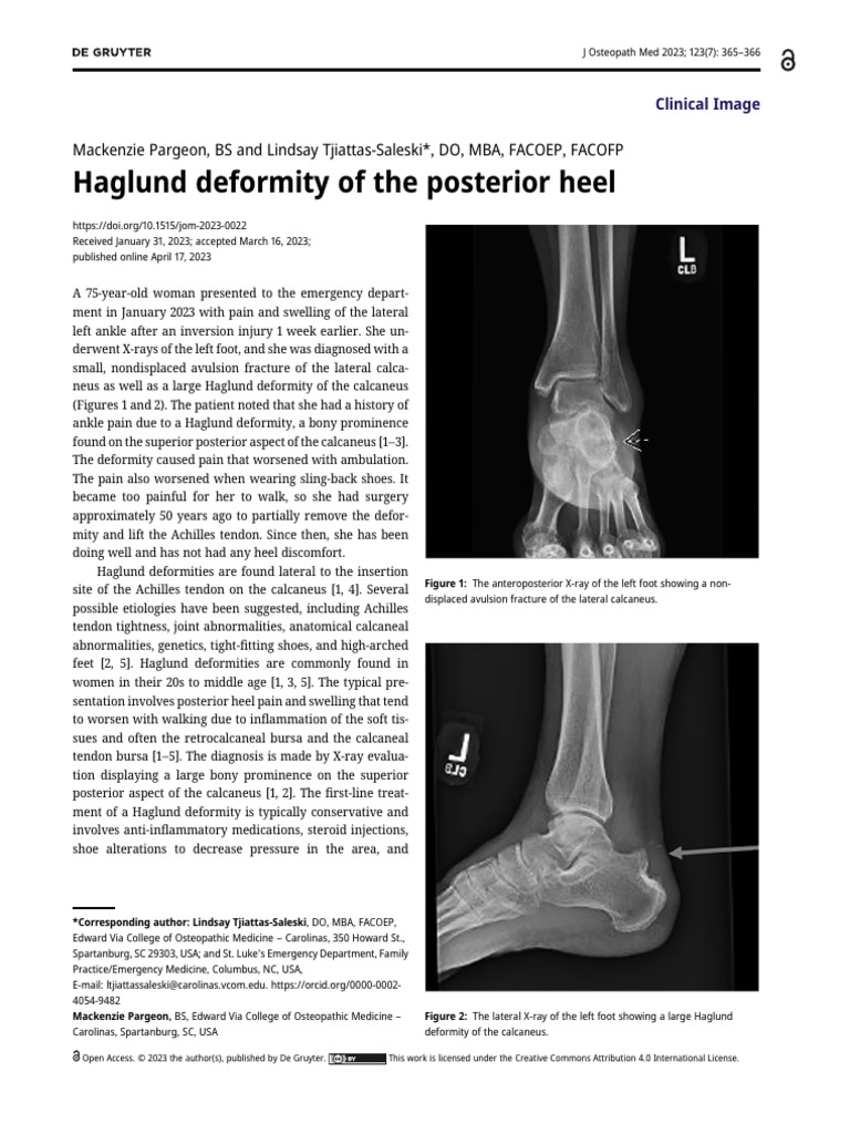 Haglund Deformity of The Posterior Heel | PDF | Foot | Musculoskeletal ...