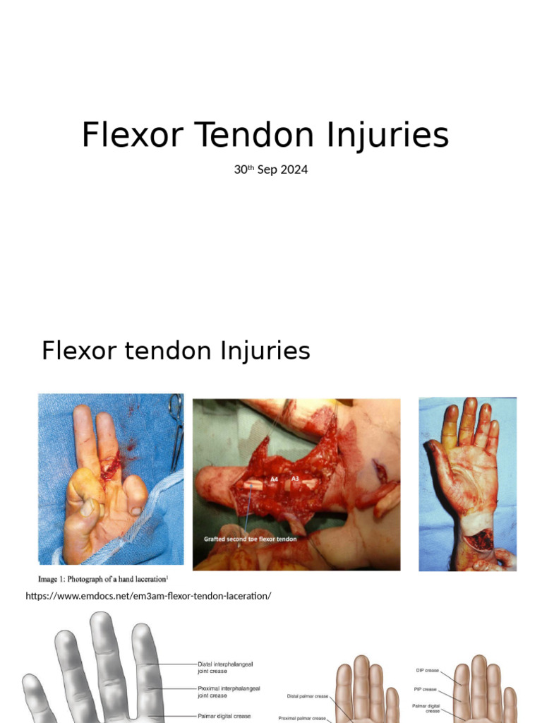Flexor Tendon Injuries | PDF | Thumb | Anatomical Terms Of Motion
