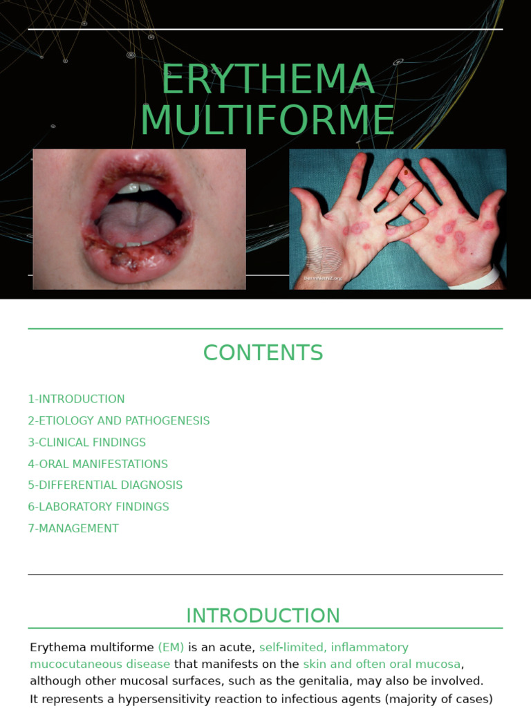 Management of Oral Erythema Multiforme | PDF | Medicine | Dermatology