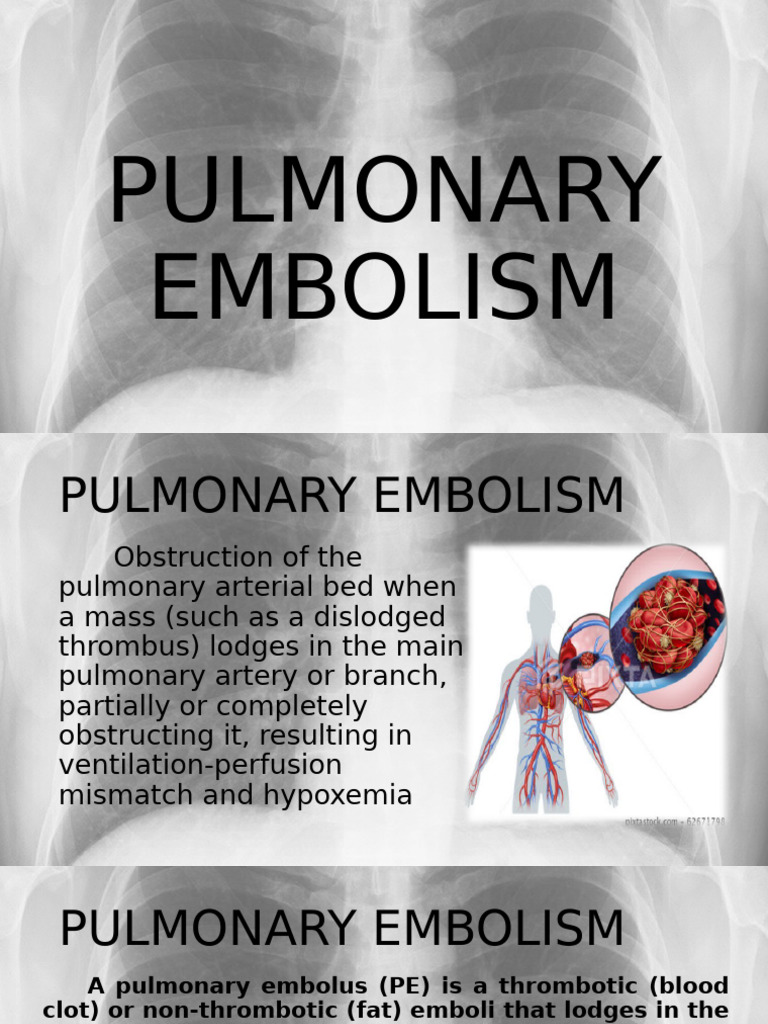PULMONARY-EMBOLISM | PDF | Embolism | Thrombosis