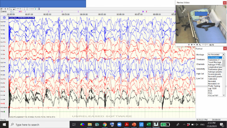 EEG Montage and Video Example | PDF