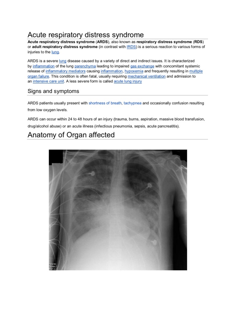 Acute Respiratory Distress Syndrome | Medical Specialties | Pulmonology