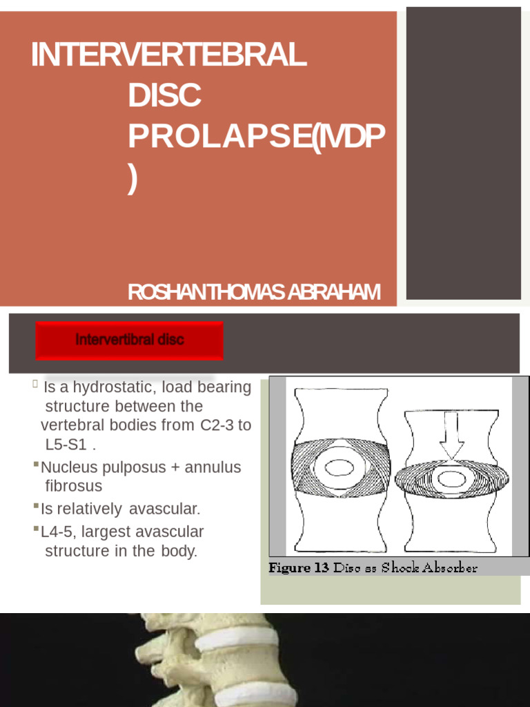 Intervertebral Disc Prolapse (Ivdp) : Roshan Thomas Abraham (MPT Neuro ...