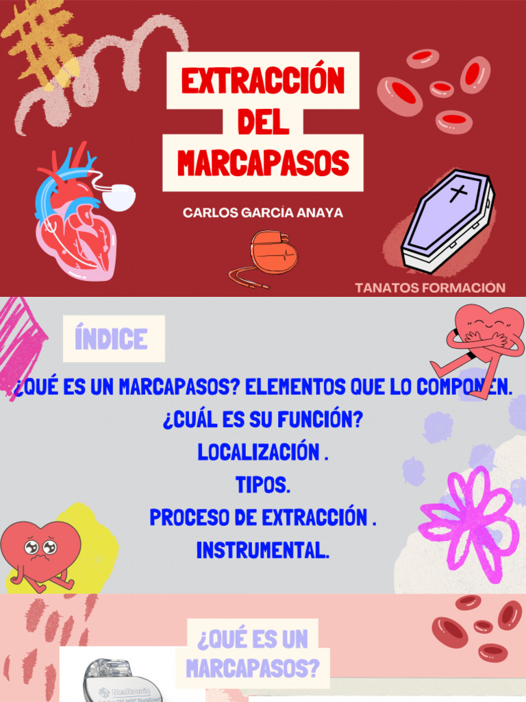 Extracción Del Marcapasos PDF | PDF