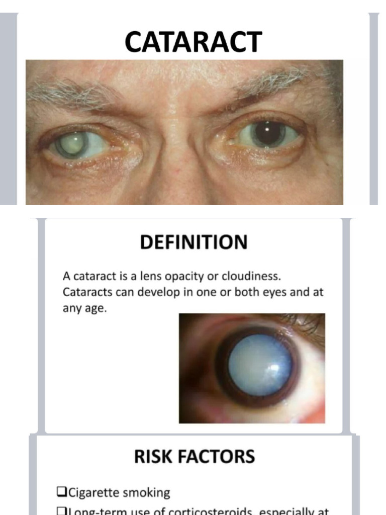 Cataract | PDF