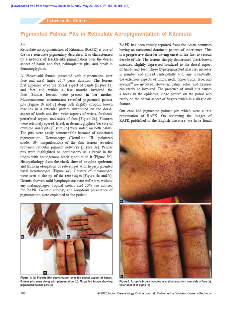 Pigmented Palmar Pits in Reticulate Acropigmentati | PDF | Hand | Epidermis