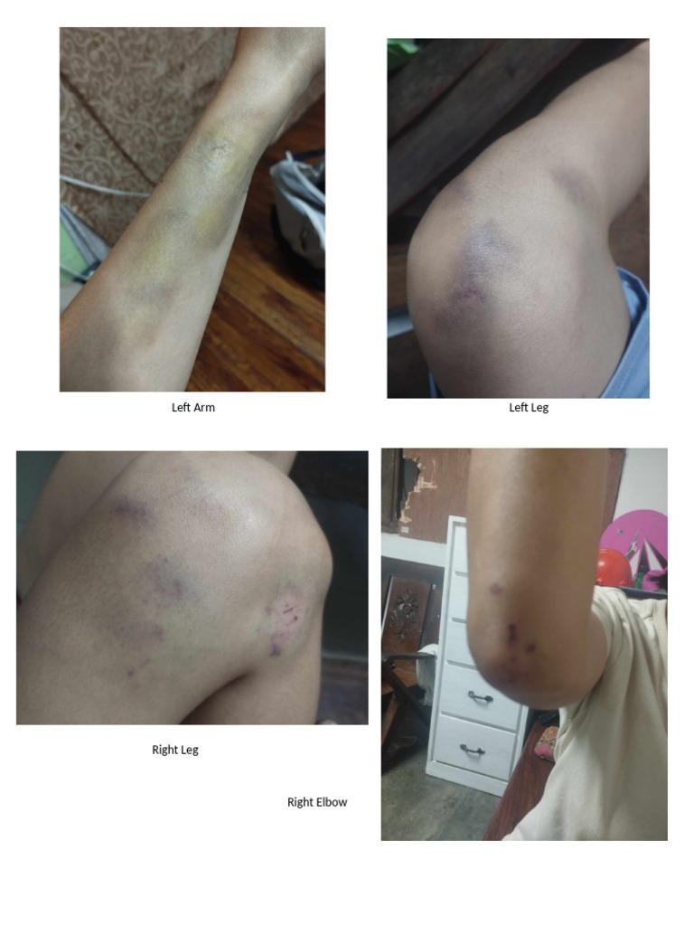 Bruises | PDF