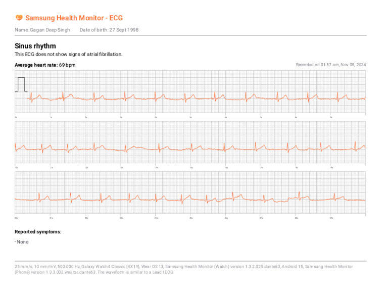 Samsung ECG Report: Sinus Rhythm | PDF