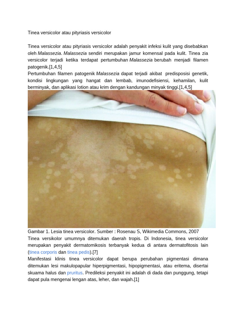 Tinea Versicolor Atau Pityriasis Versicolor | PDF | Kesehatan Holistik ...