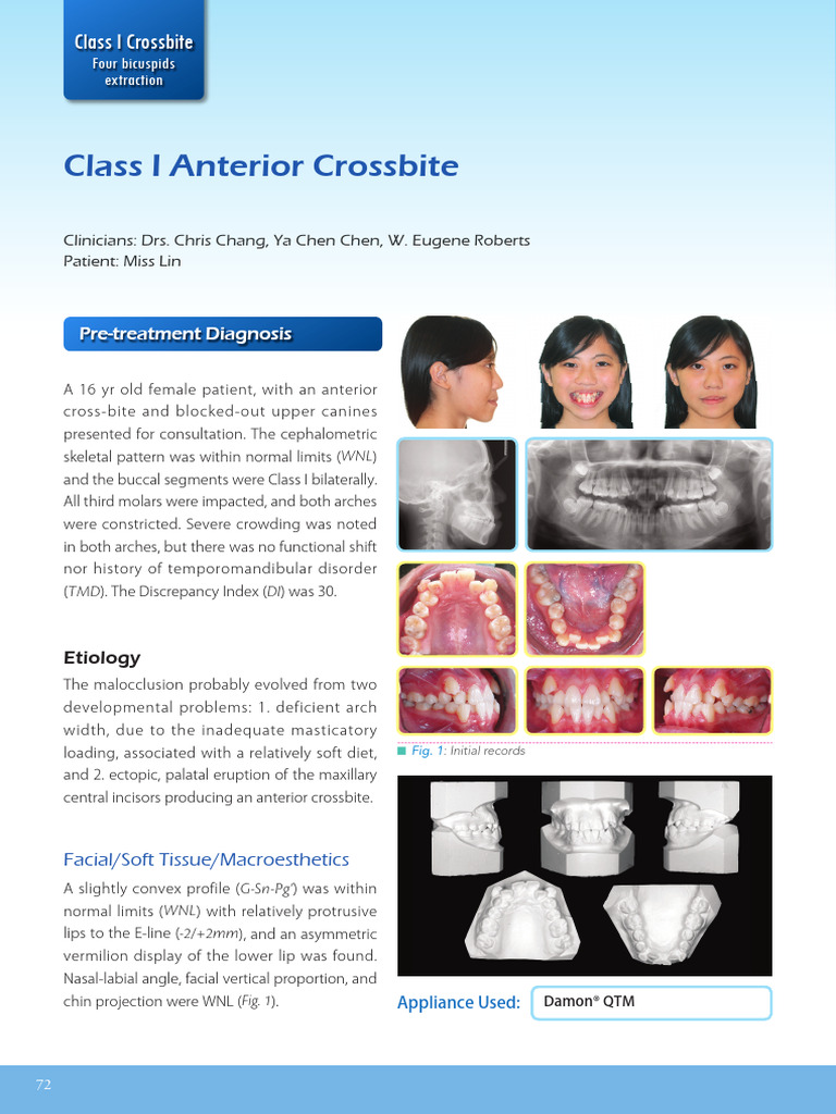 Class I Anterior Crossbite | PDF | Dentistry Branches | Dental Anatomy