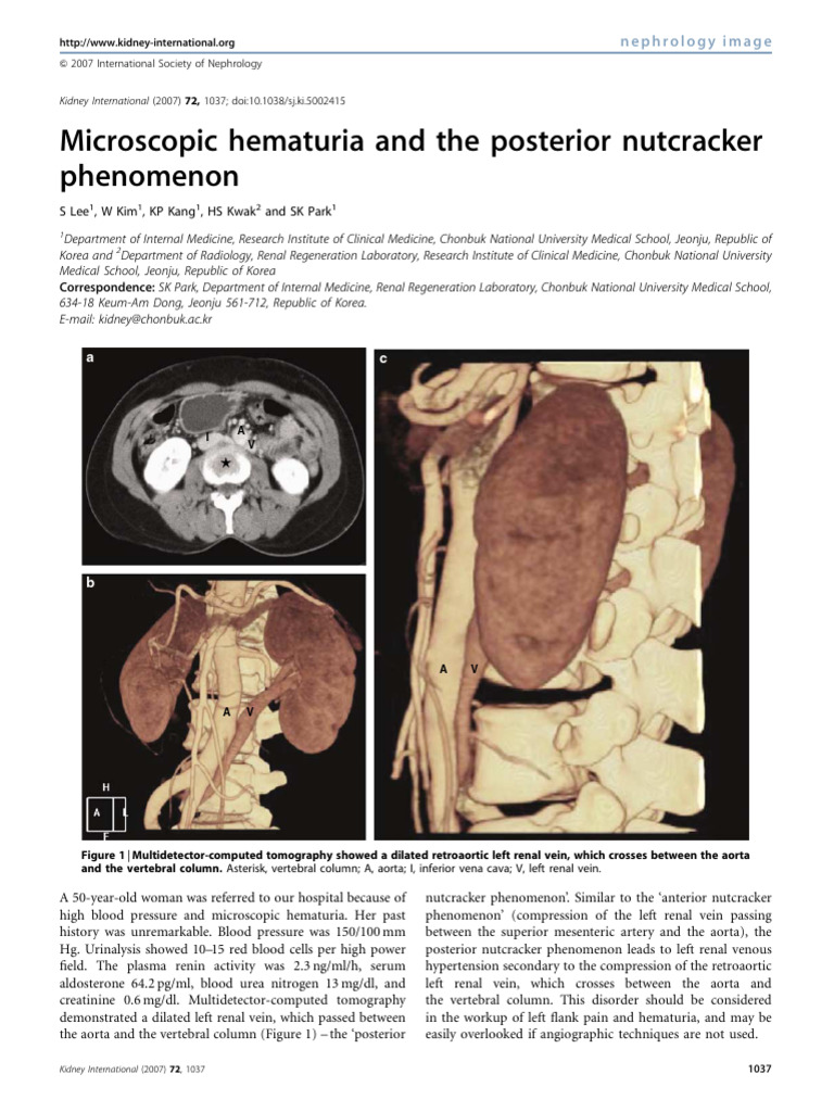 Microscopic Hematuria and The Posterior Nutcracker | PDF | Kidney | Vein